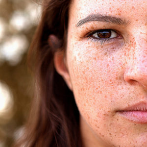 Efelidi cosa sono , cause e come evitarle | VigilaSalute