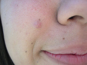 Brufoli interni, perchè si formano e quando schiacciarli | VigilaSalute